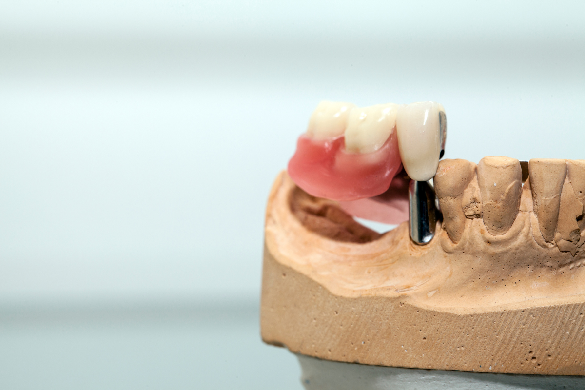 Stable, Comfortable, and Beautiful Smiles with Implant Dentures